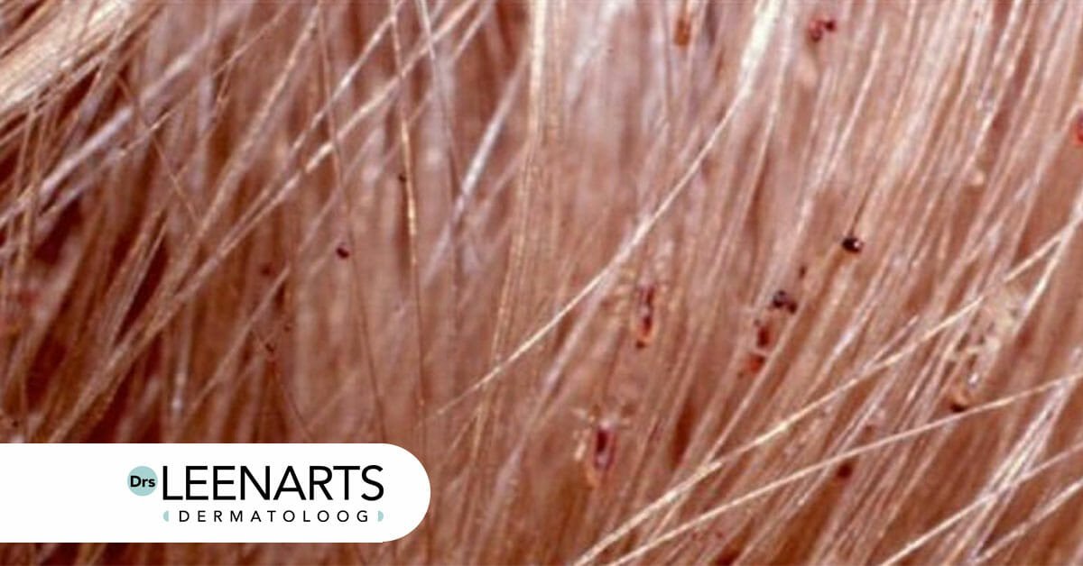 Mehr Läuse nach den Sommerferien? | Dr Leenarts