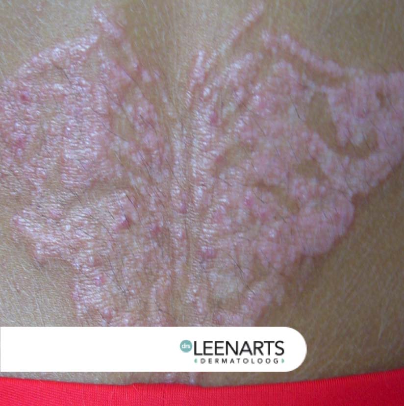 Ausschlag Durch Henna Tattoos Henna Tattoo? Vorsicht! | Dr Leenarts