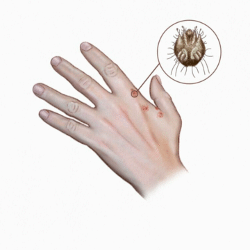 Scabies (Krätze) | Ursache, Beschwerden & Tipps | Dr Leenarts
