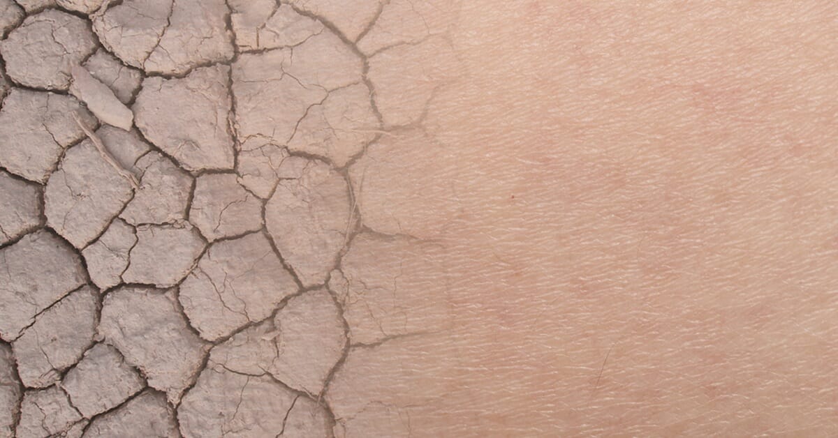 Rissige Haut I Pflege und Tipps | Dr. Leenarts