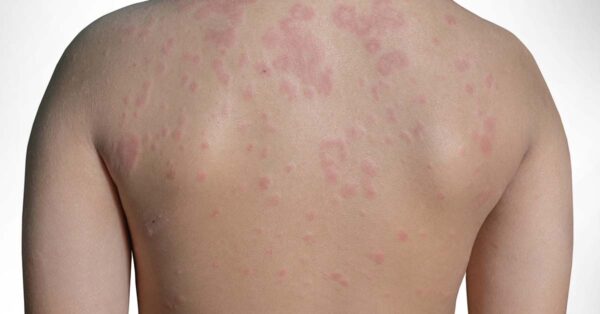 Insektenstiche erkennen & behandeln | Dr Leenarts