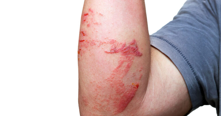Eichenprozessionsspinnerraupe (Ausschlag) | Dr Leenarts | Dermatologin