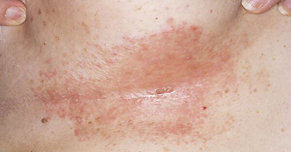 Warzen | Ursache, Behandlung & Tipps | Dr Leenarts