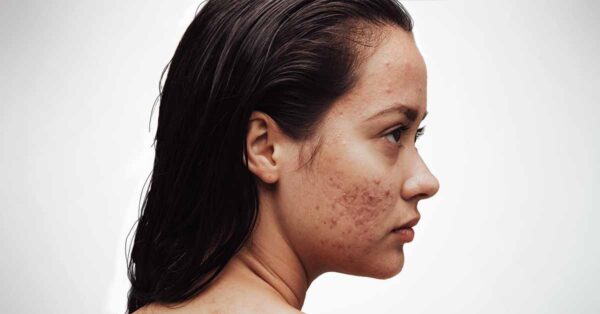 Narben | Verlauf, Beschwerden, Pflege | Dr Leenarts