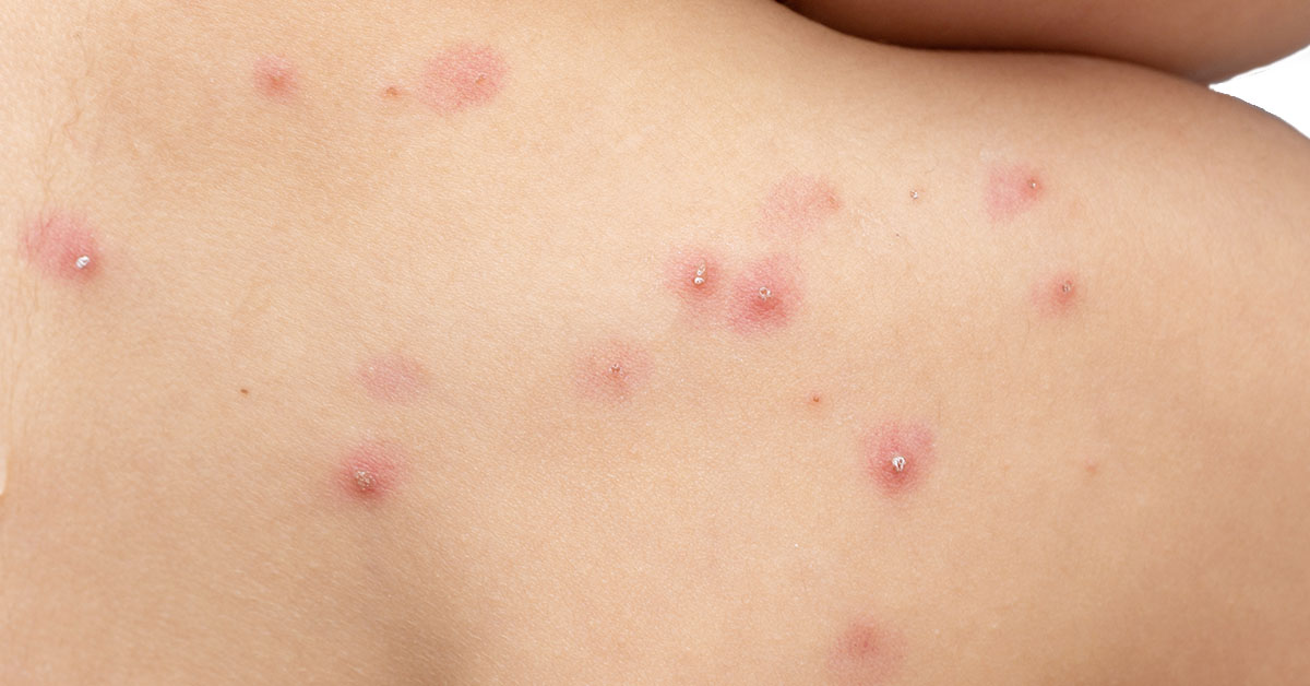 Windpocken | Ursache, Verlauf & Tipps | Dr Leenarts